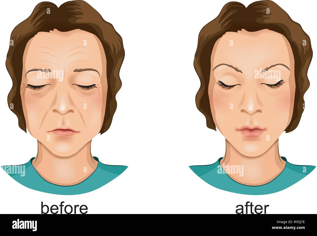 vector illustration of a plastic face. before and after Stock Vector ...