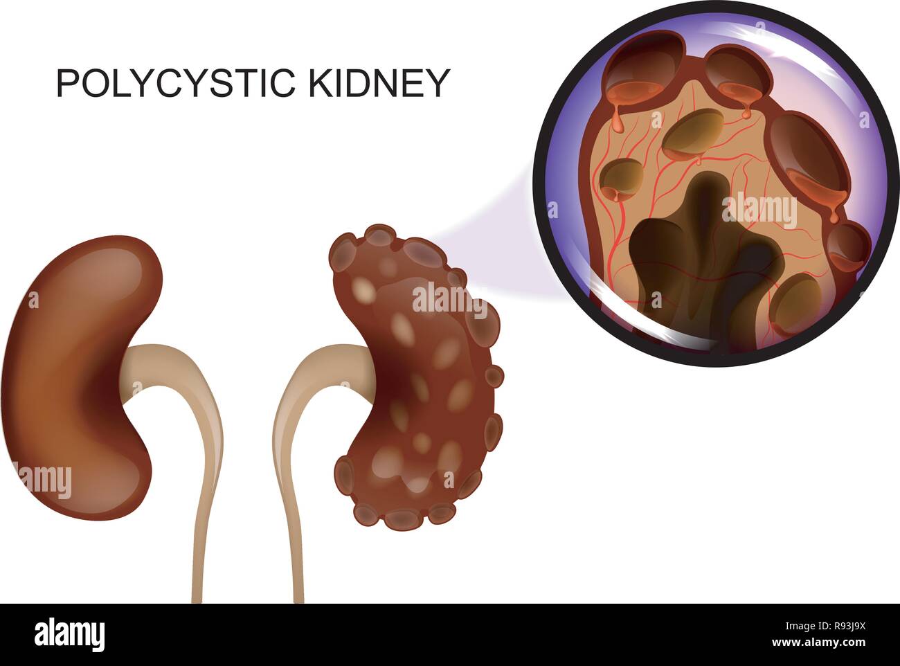 vector illustration of a healthy kidney and a kidney afflicted with ...