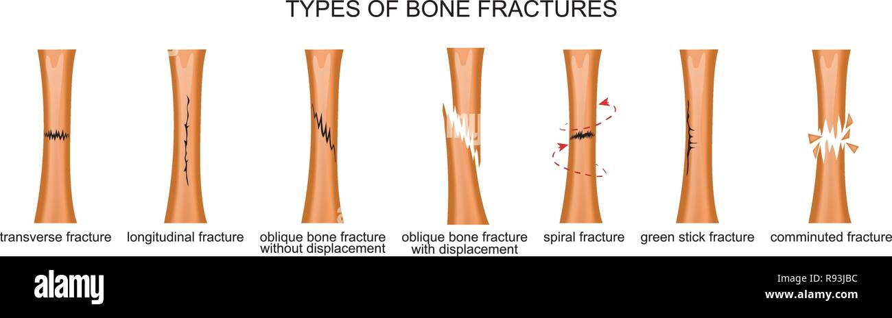 vector illustration of the types of bone fractures Stock Vector Image ...