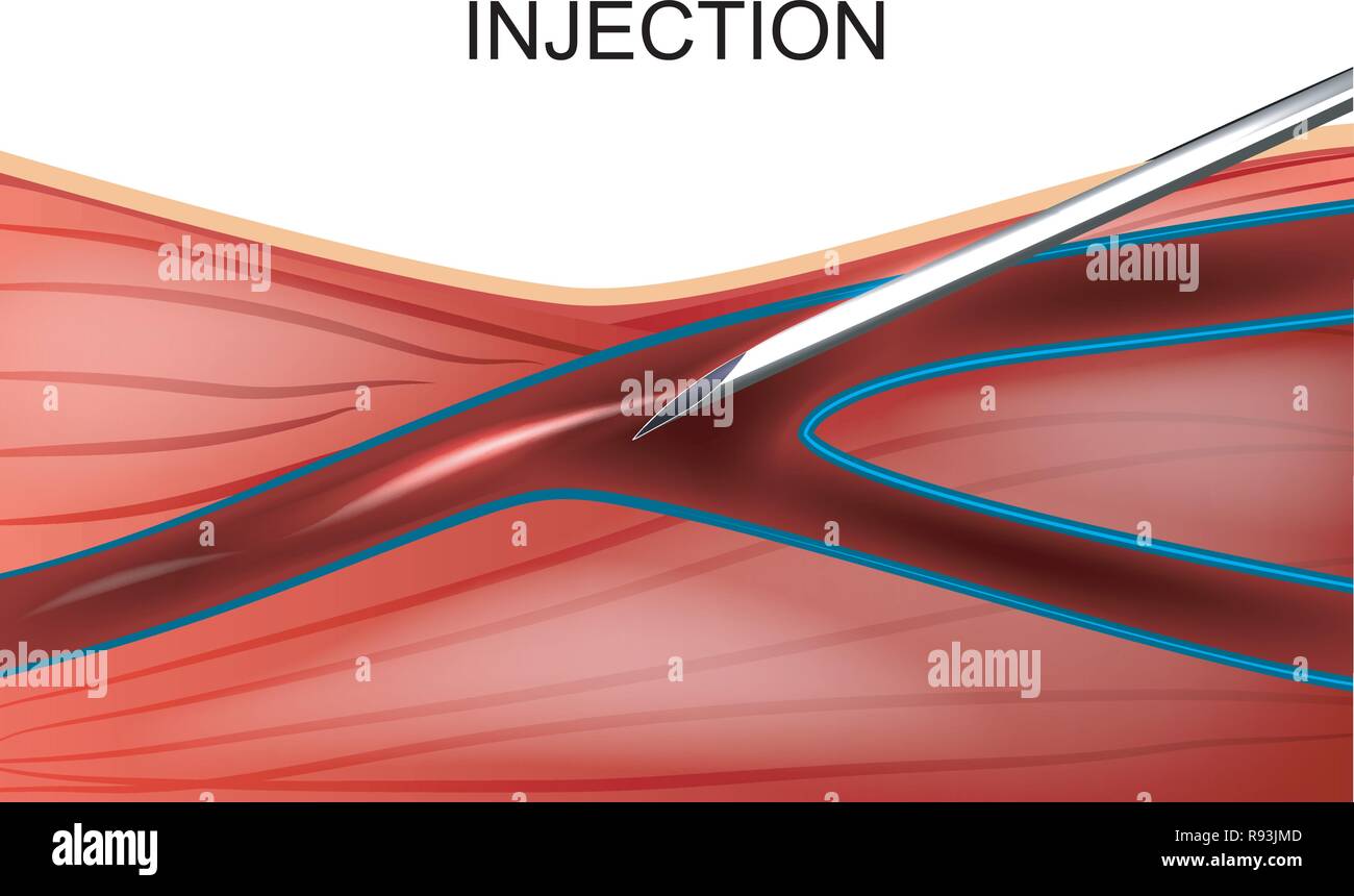 vector illustration of the intravenous injection of drugs Stock Vector ...
