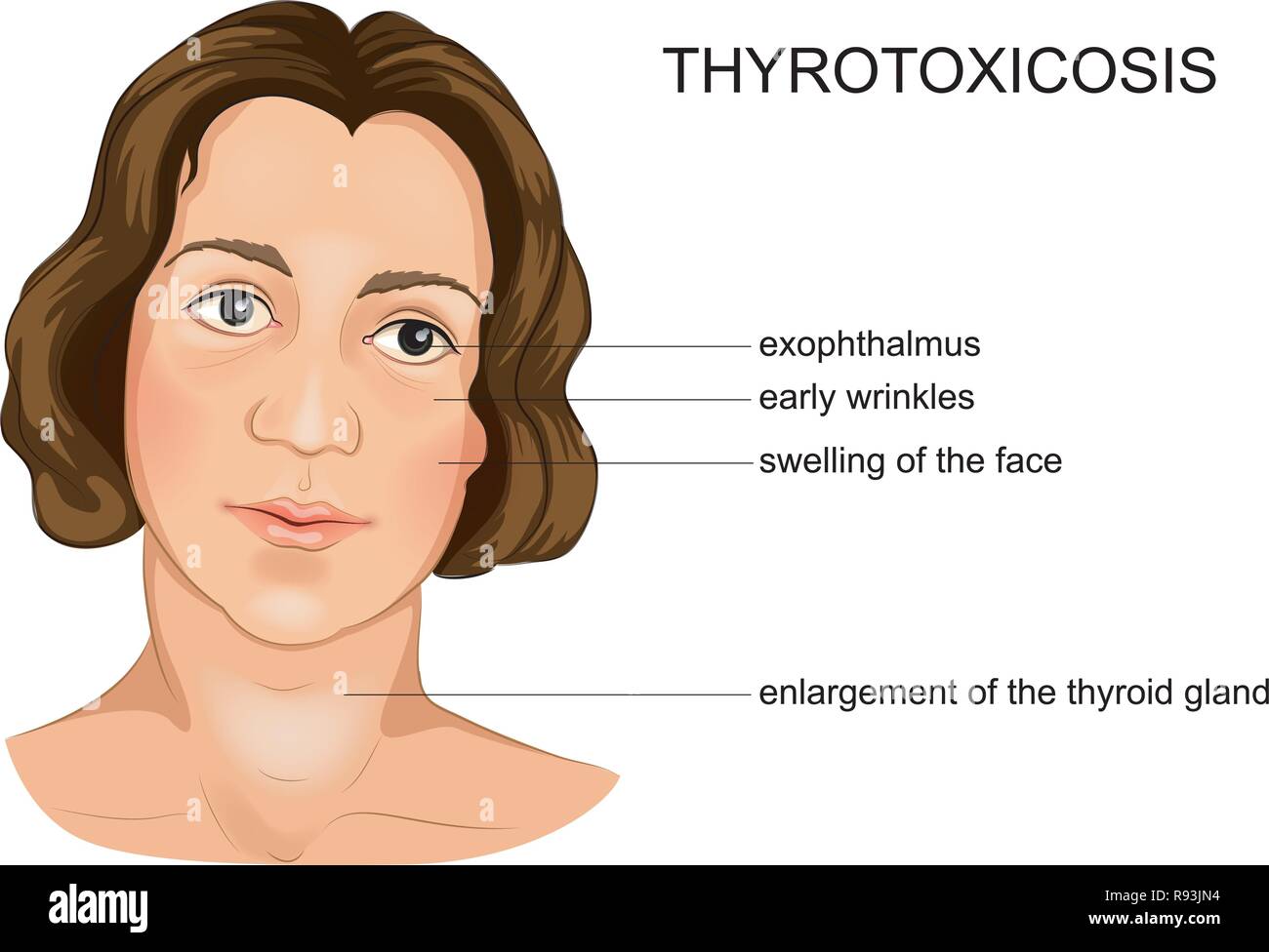 Hyperthyroidism Face