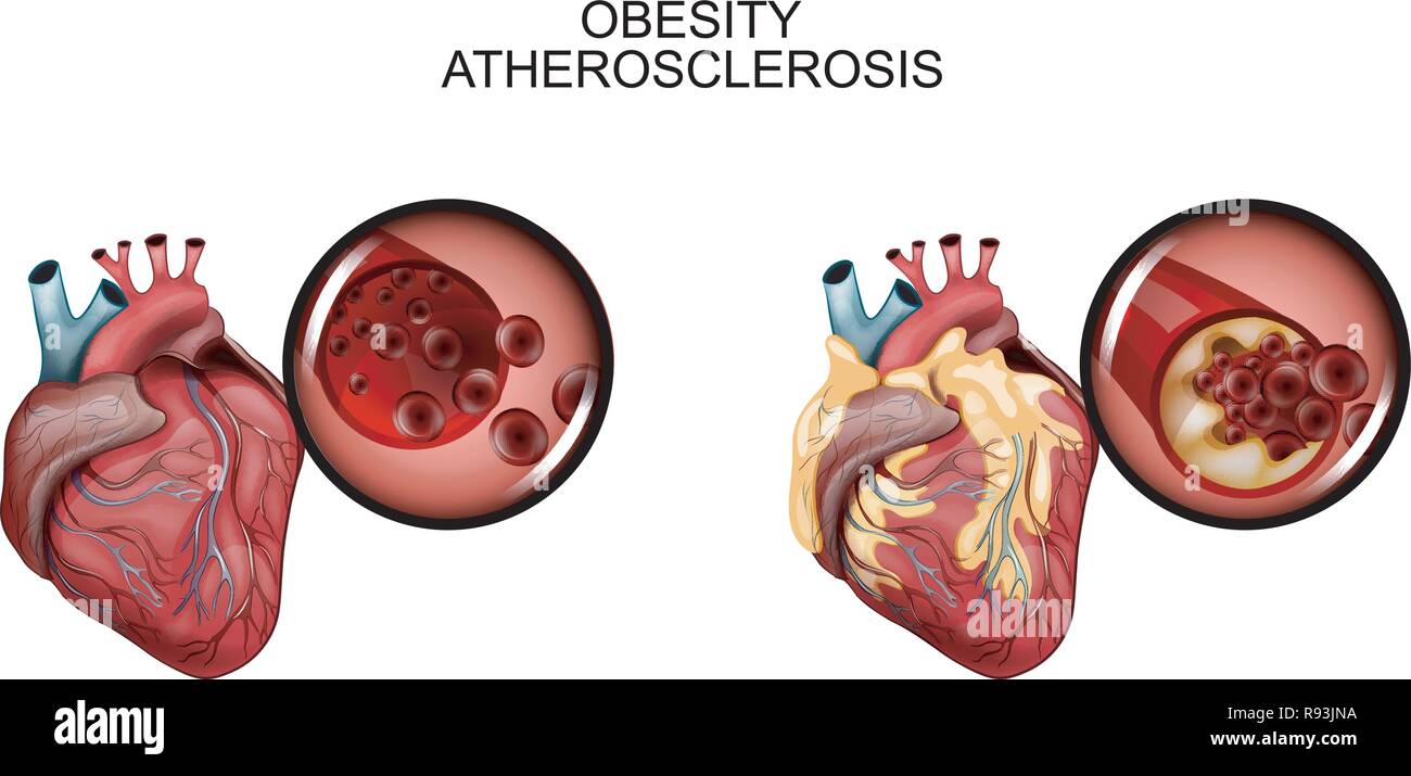 Atherosclerosis aorta hi-res stock photography and images - Alamy