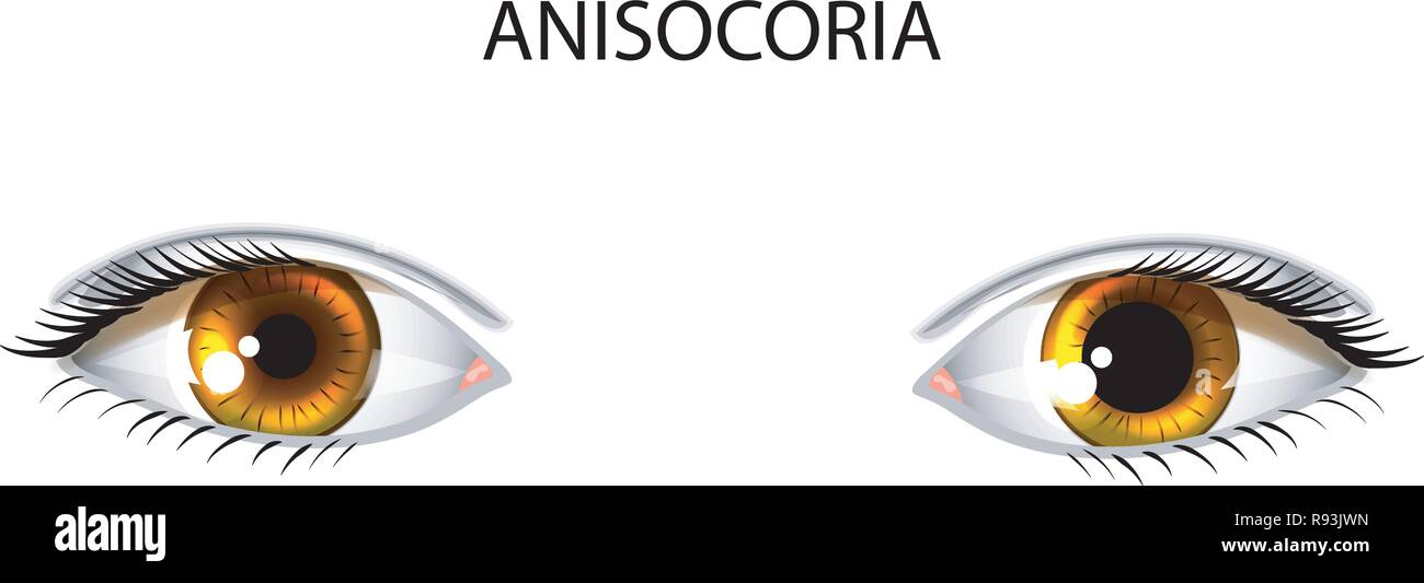 Anisocoria