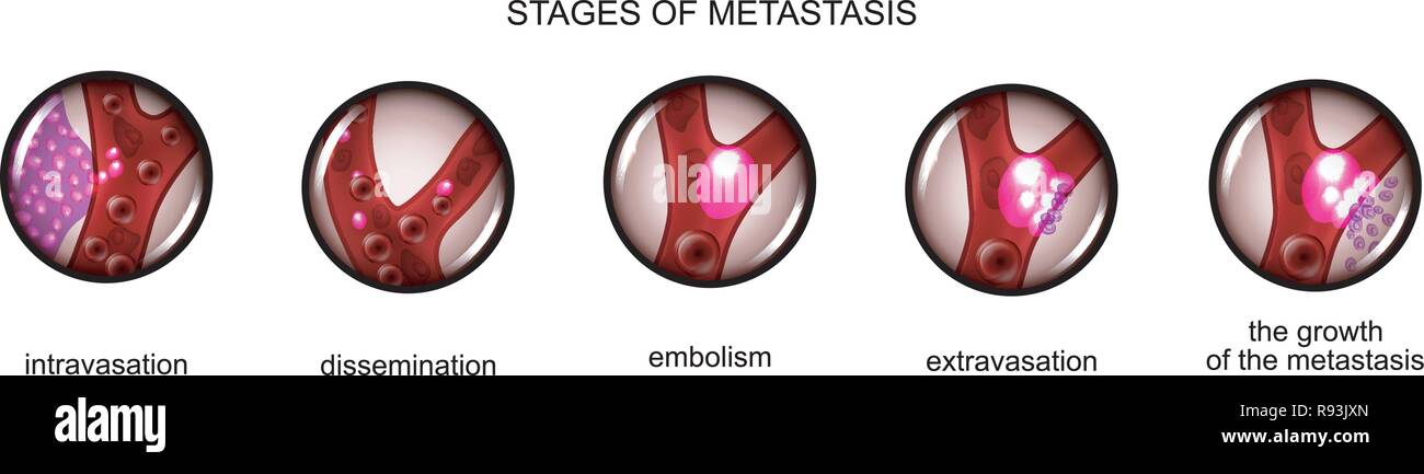 vector illustration of the stage of metastasis of cancer cells Stock ...