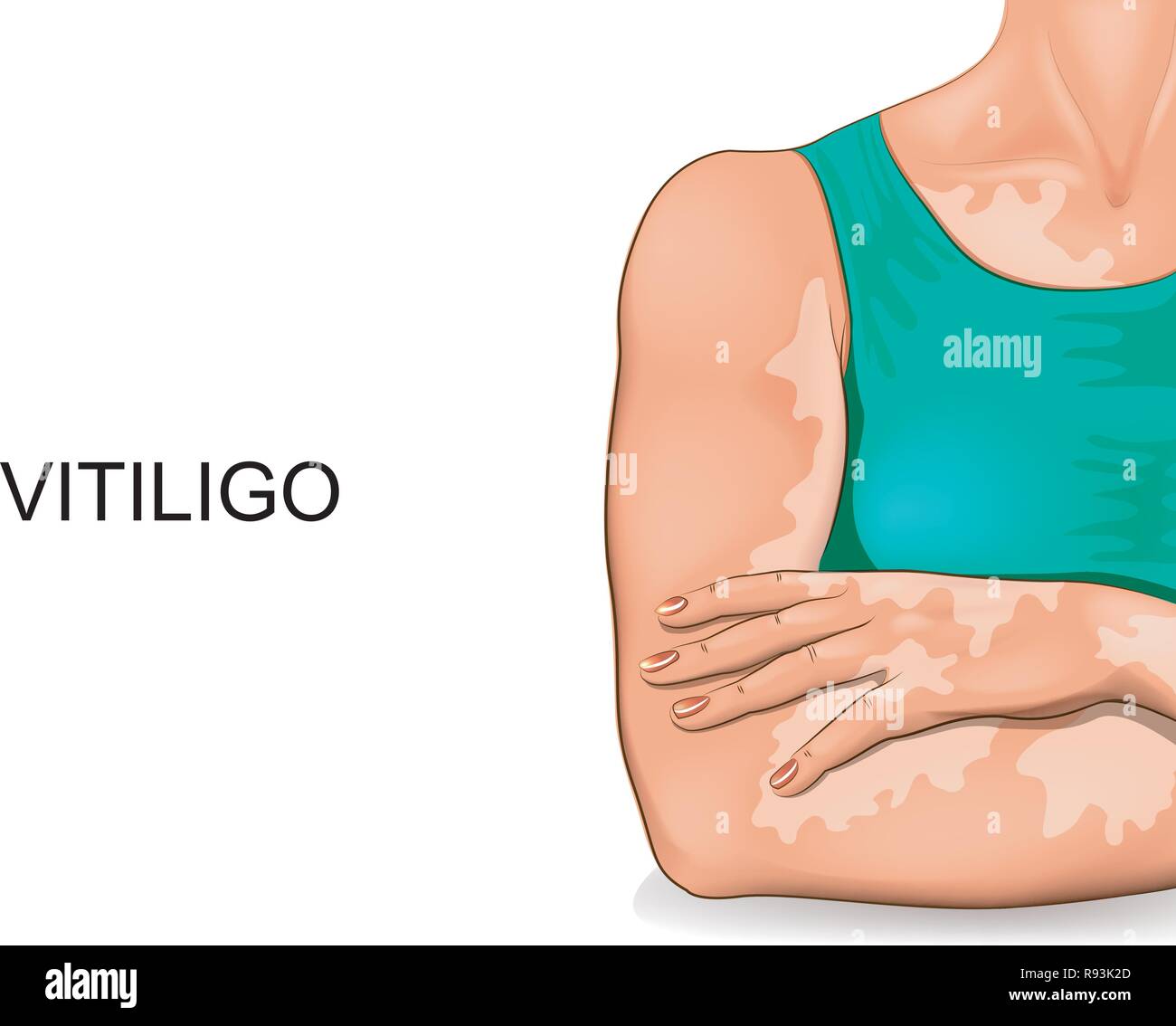 Vitiligo treatment vector vectors hi-res stock photography and images ...