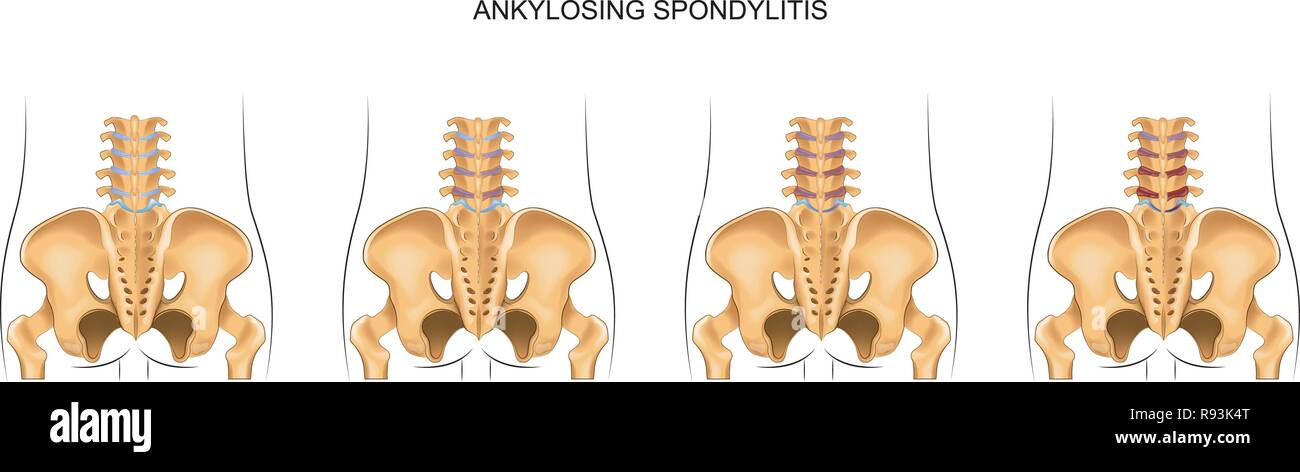 Ankylosing spondylitis hi-res stock photography and images - Alamy