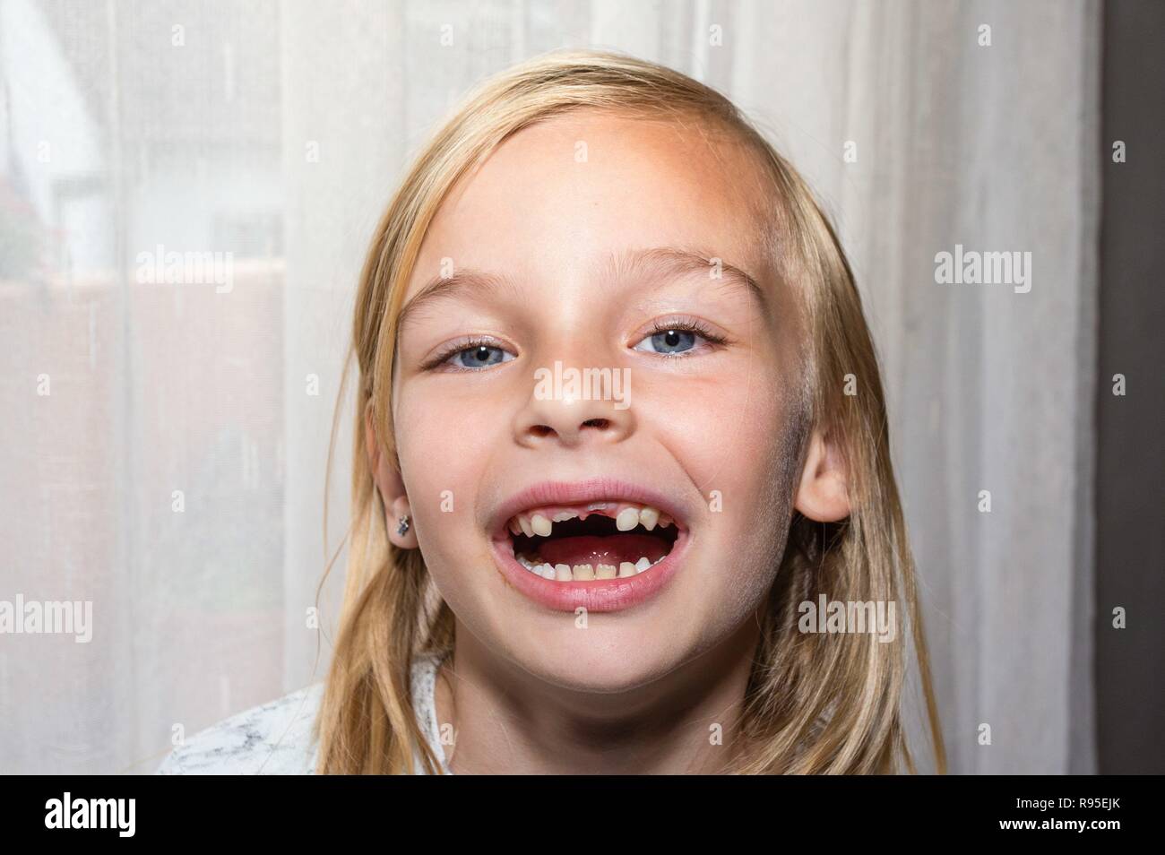A seven year old girl with two missing upper incisor smiling ...