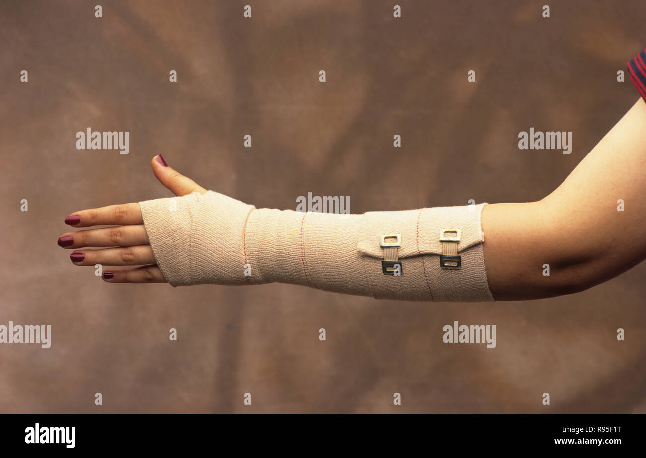Fractured hand hi-res stock photography and images - Alamy