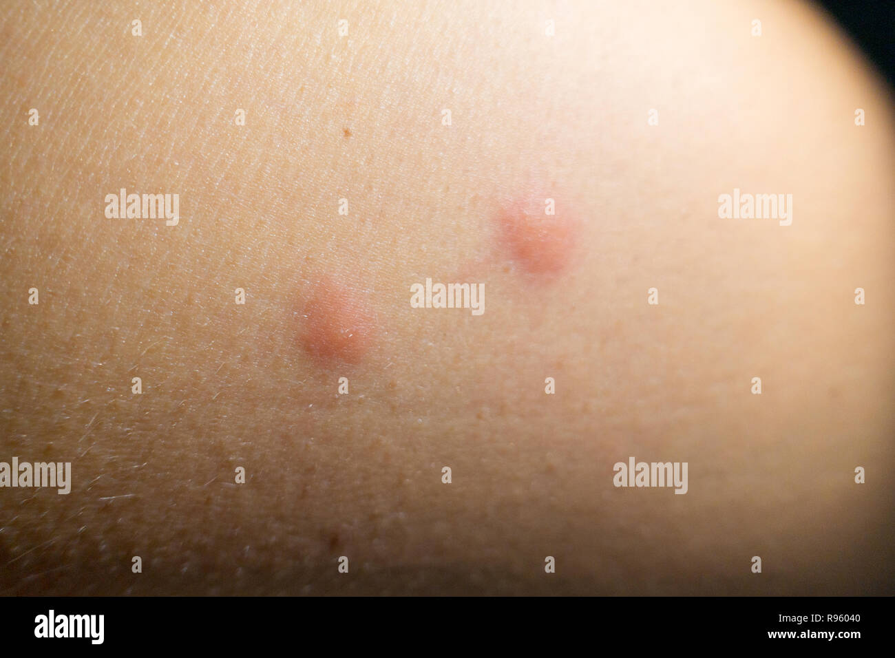 Insect bites on female hand Stock Photo - Alamy