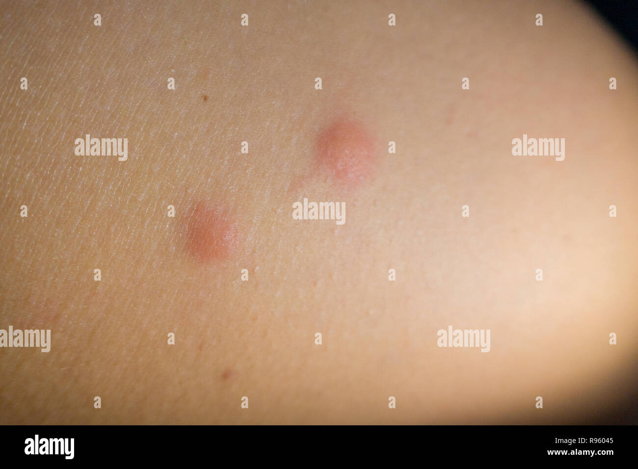 Insect bites on female hand Stock Photo - Alamy