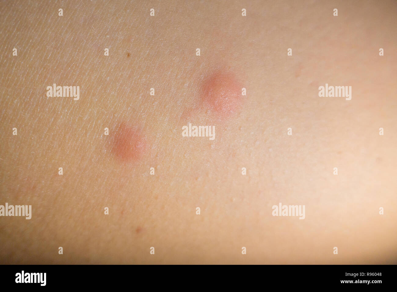 Insect bites on female hand Stock Photo - Alamy