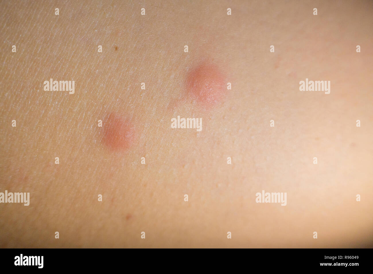 Tick bite baby hi-res stock photography and images - Alamy