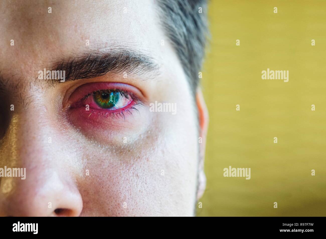 Swollen eyelid hi-res stock photography and images - Alamy