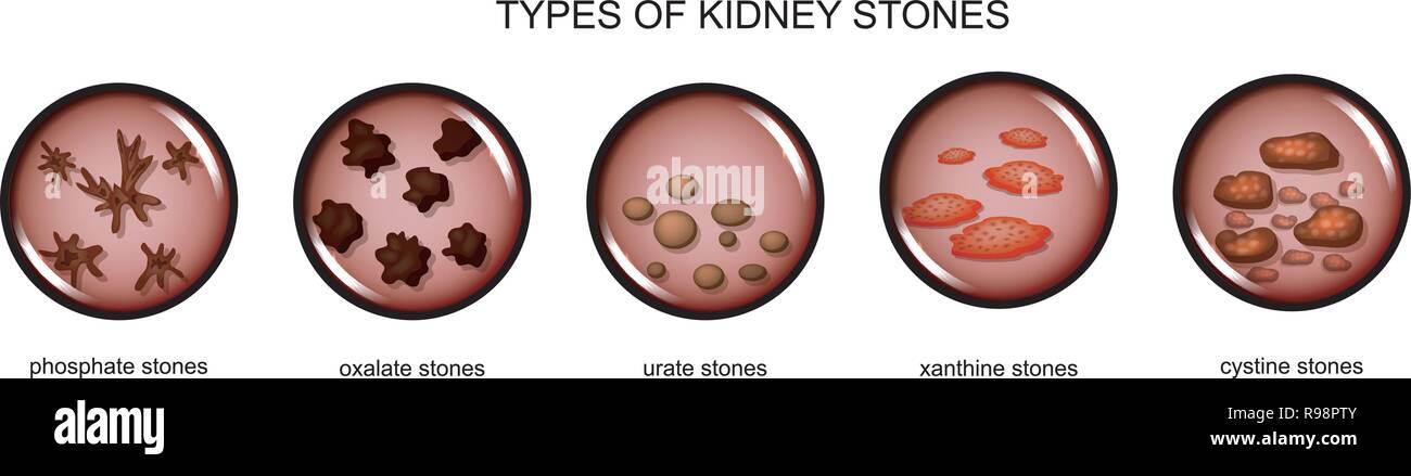 vector illustration of types of kidney stones Stock Vector Image & Art ...