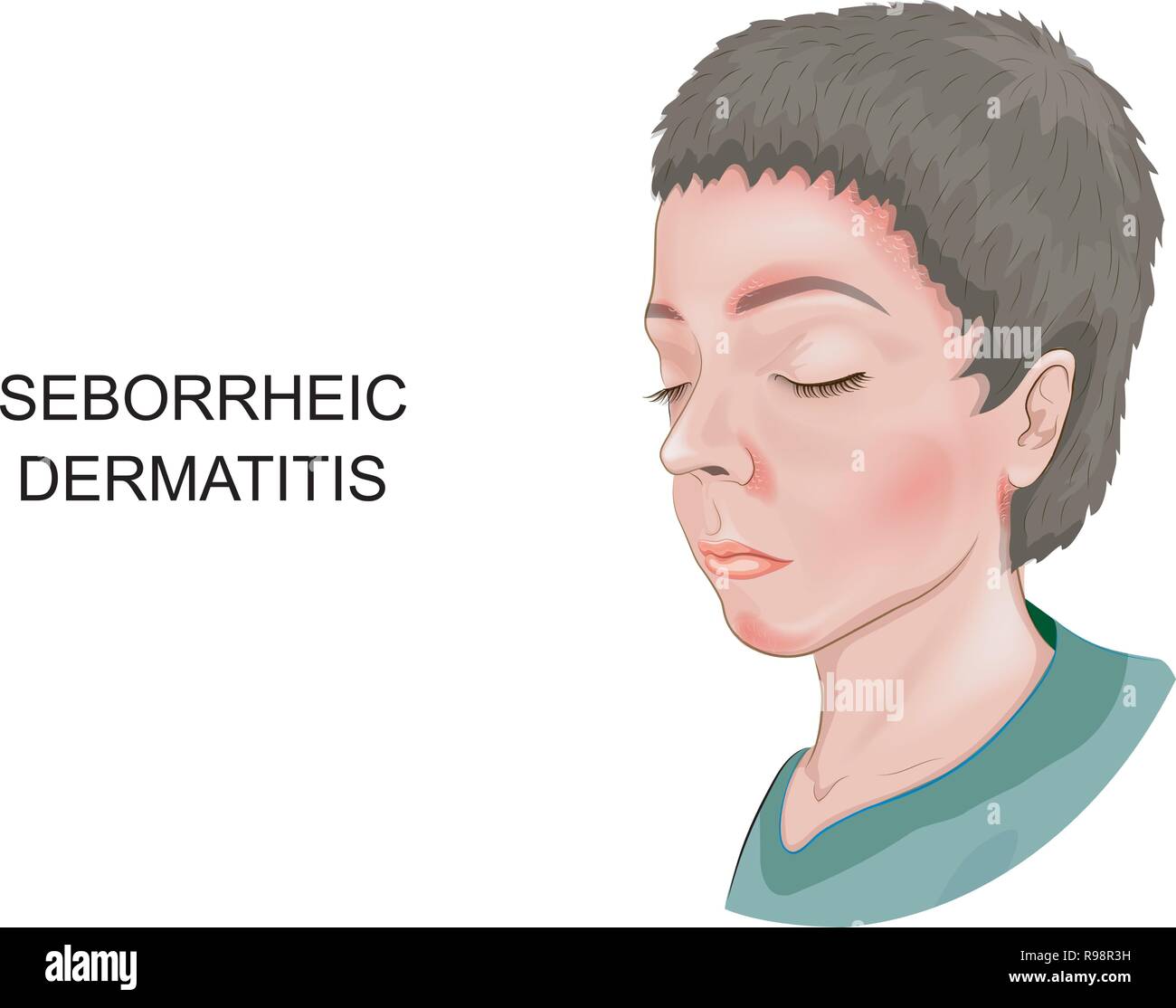 vector illustration of seborrheic dermatitis of the skin Stock Vector ...