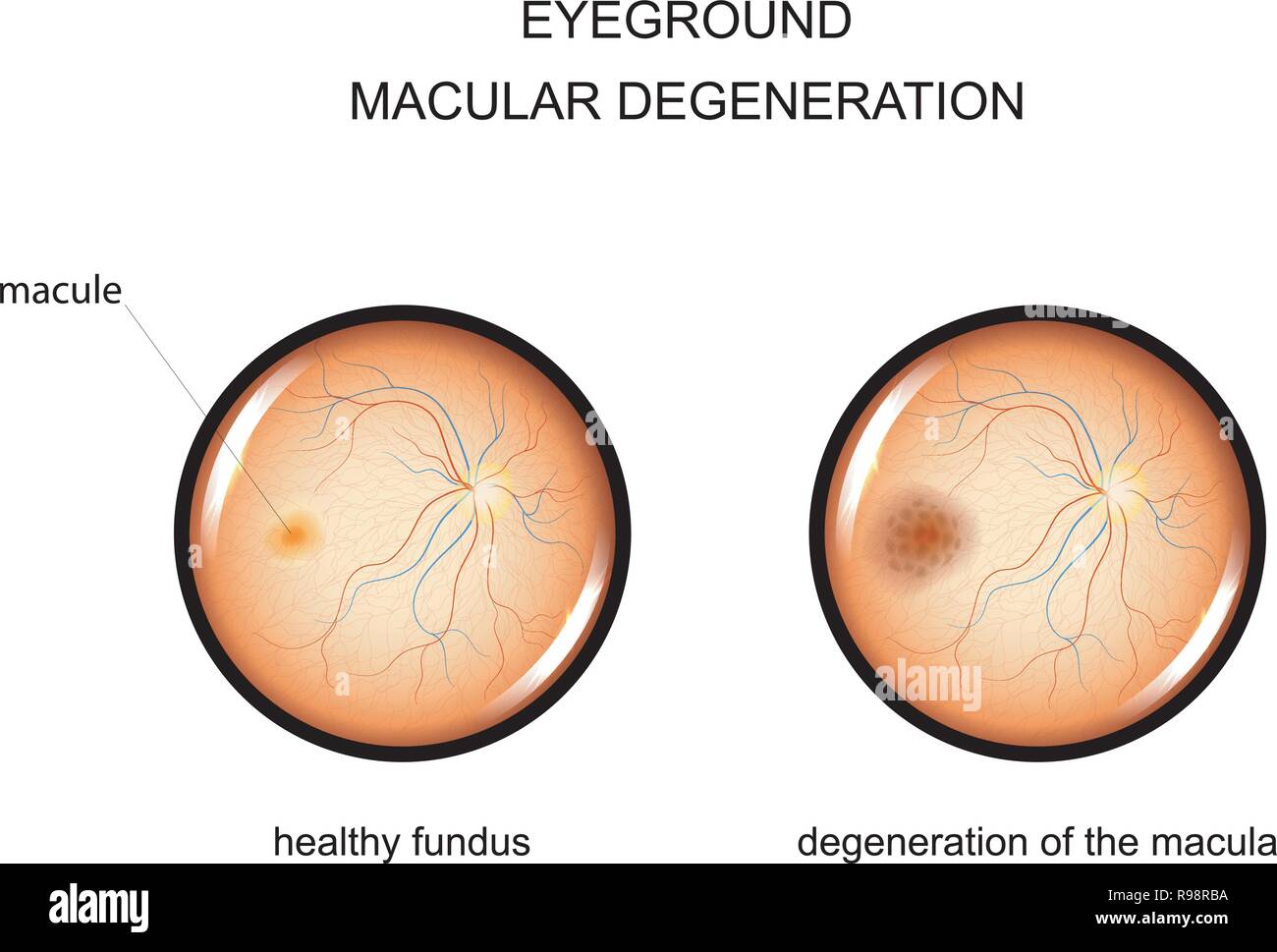 vector illustration of the fundus. degeneration of the macula Stock ...