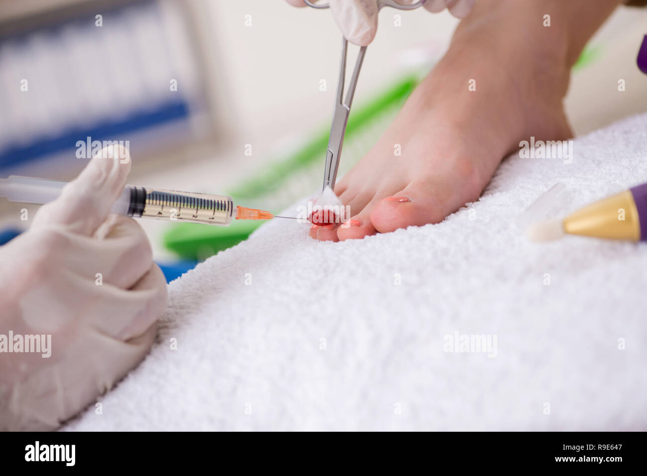 Podiatrist treating feet during procedure Stock Photo - Alamy