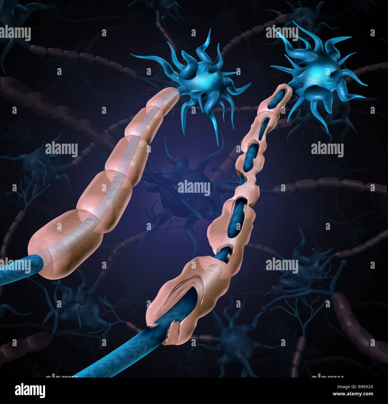 Multiple sclerosis damaged myelin or MS autoimmune disease with healthy ...