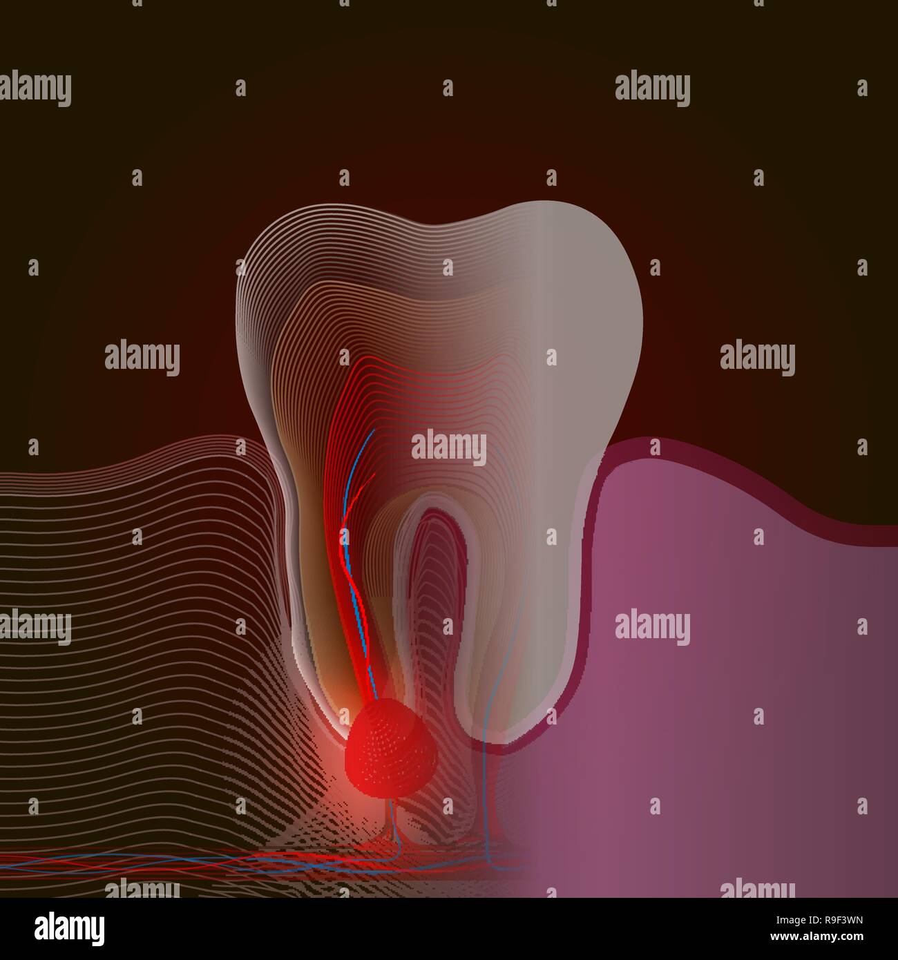 X-ray effect. The transition from a real tooth to a linear x-ray effect ...