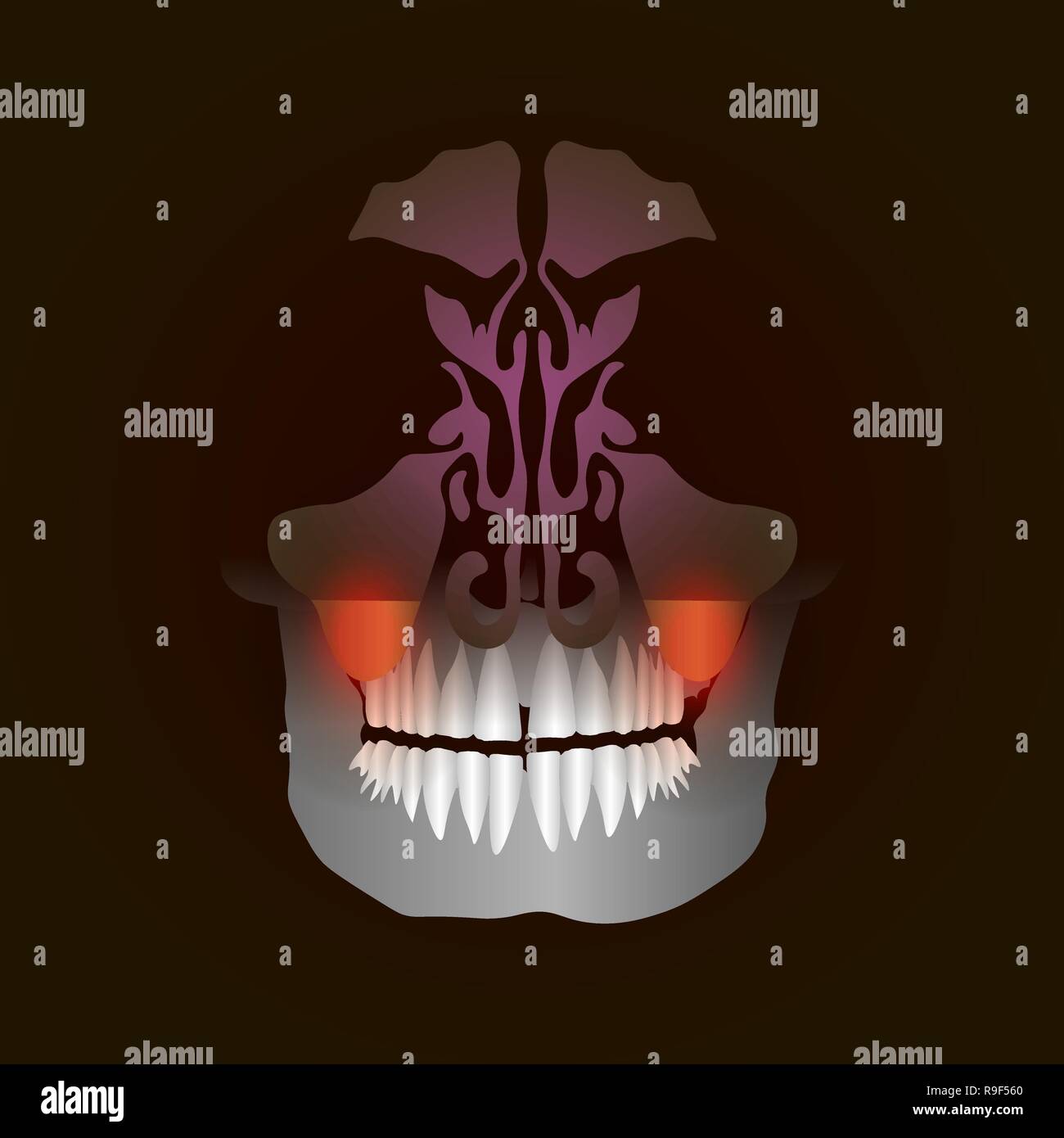 Odontogenic sinusitis. Inflammation of the maxillary sinuses due to a ...