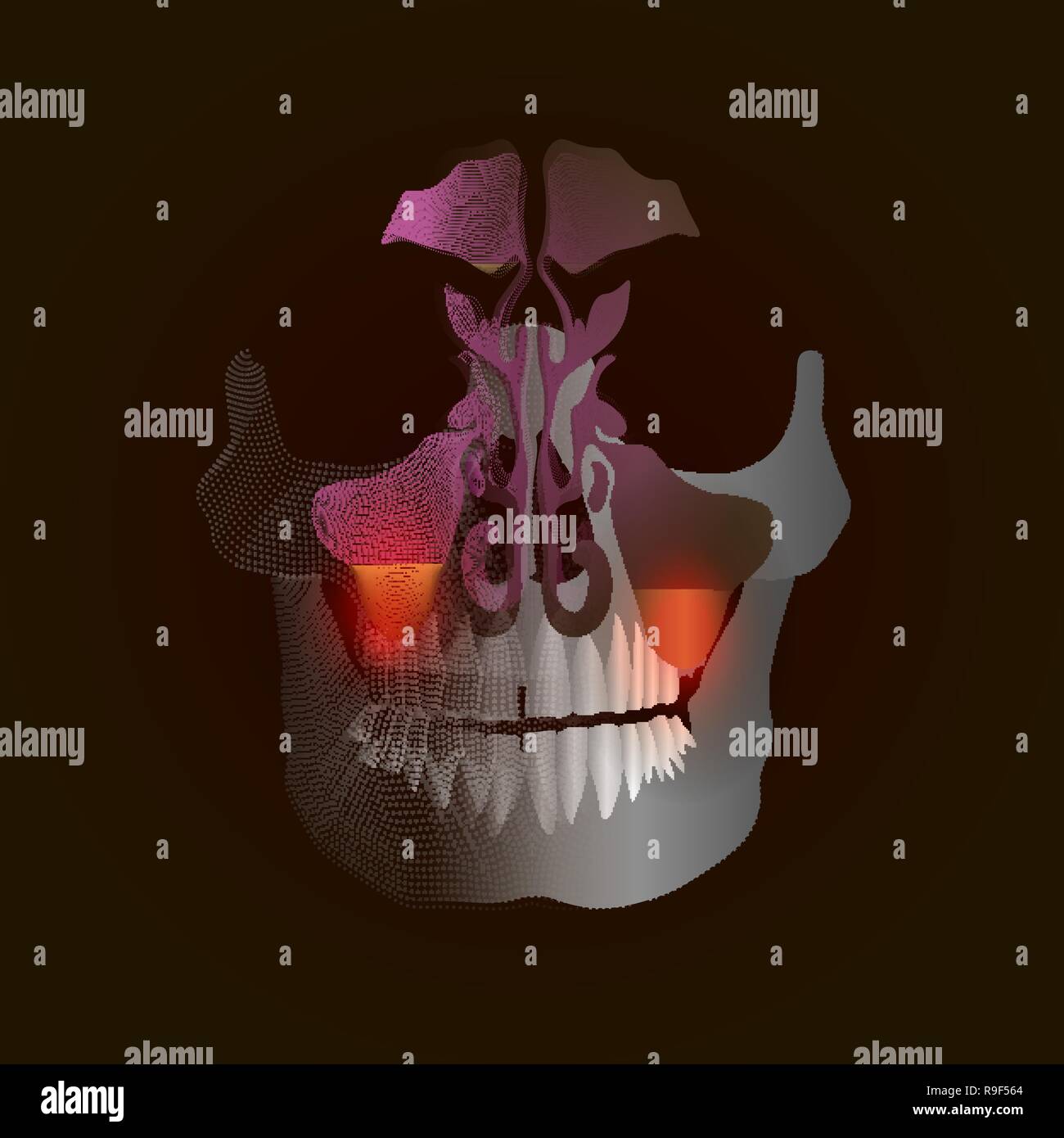 Cold abscess Stock Vector Images - Alamy