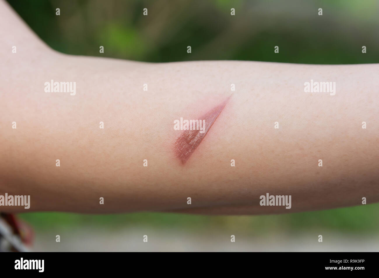 Scald hi-res stock photography and images - Alamy