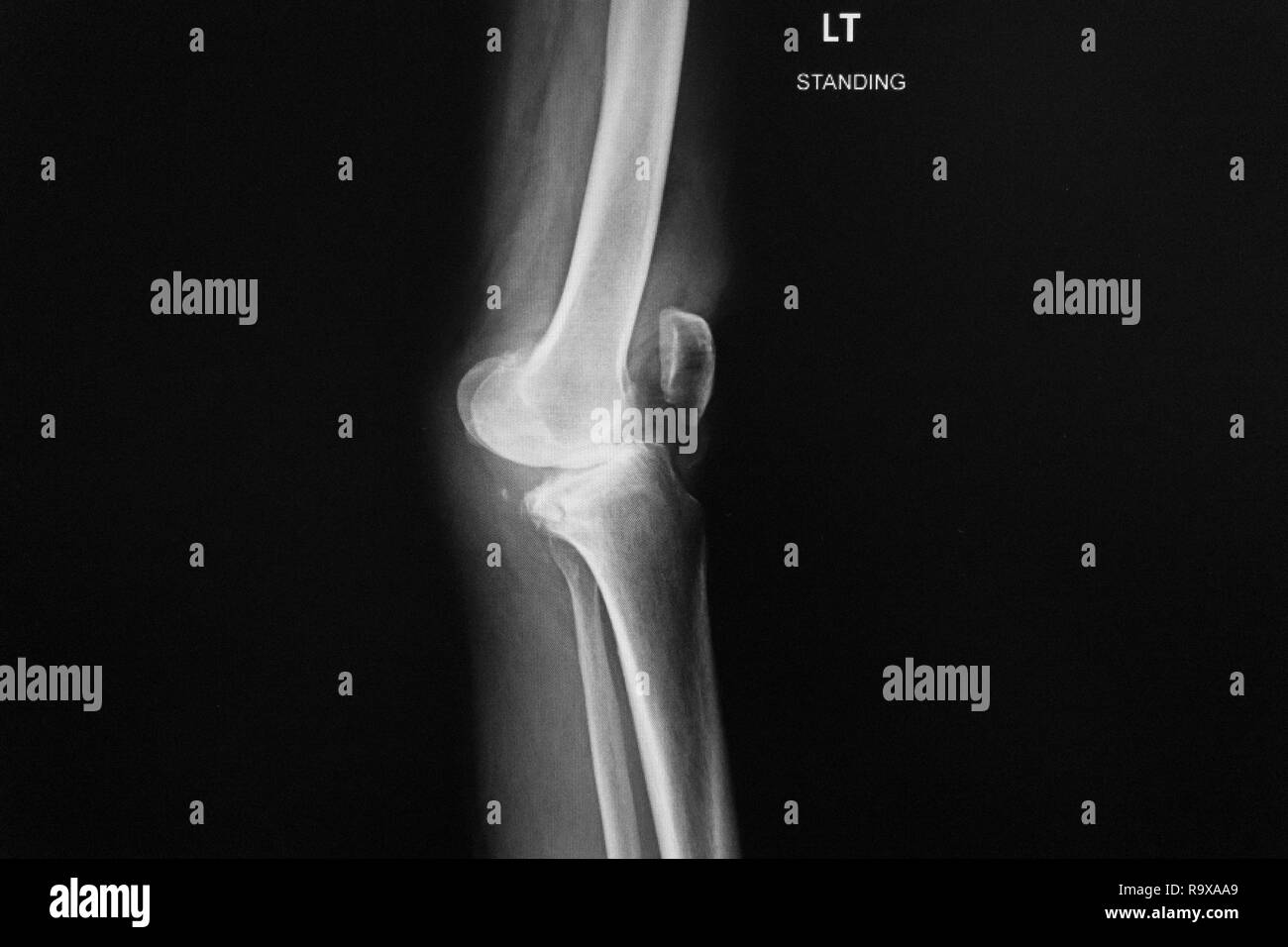 Left knee Black and White Stock Photos & Images - Alamy