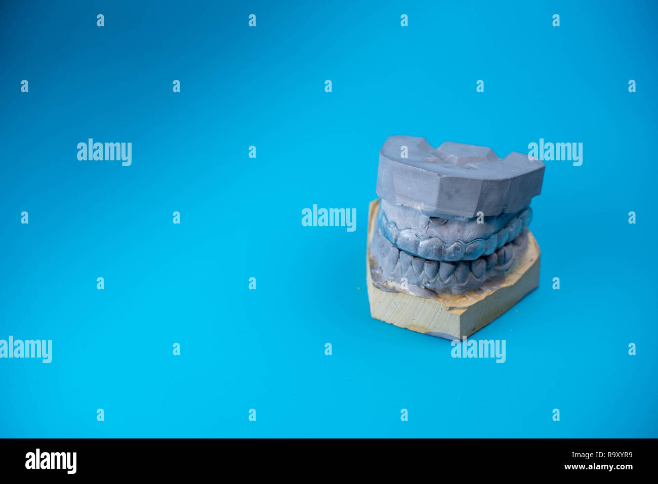 Molds of the jaw. dental splint. Dental implants on blue background ...