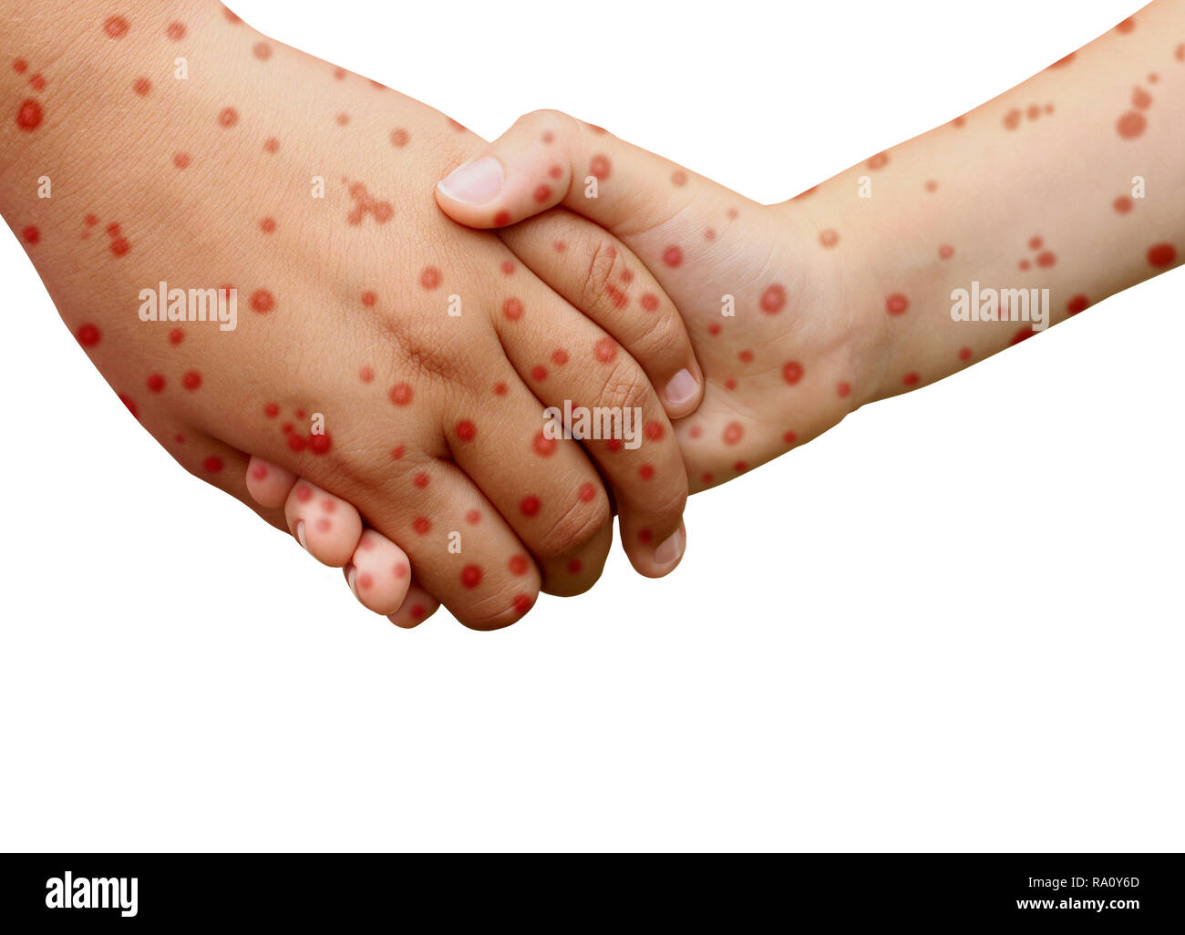 Measles disease concept and viral illness as a contagious chickenpox or ...