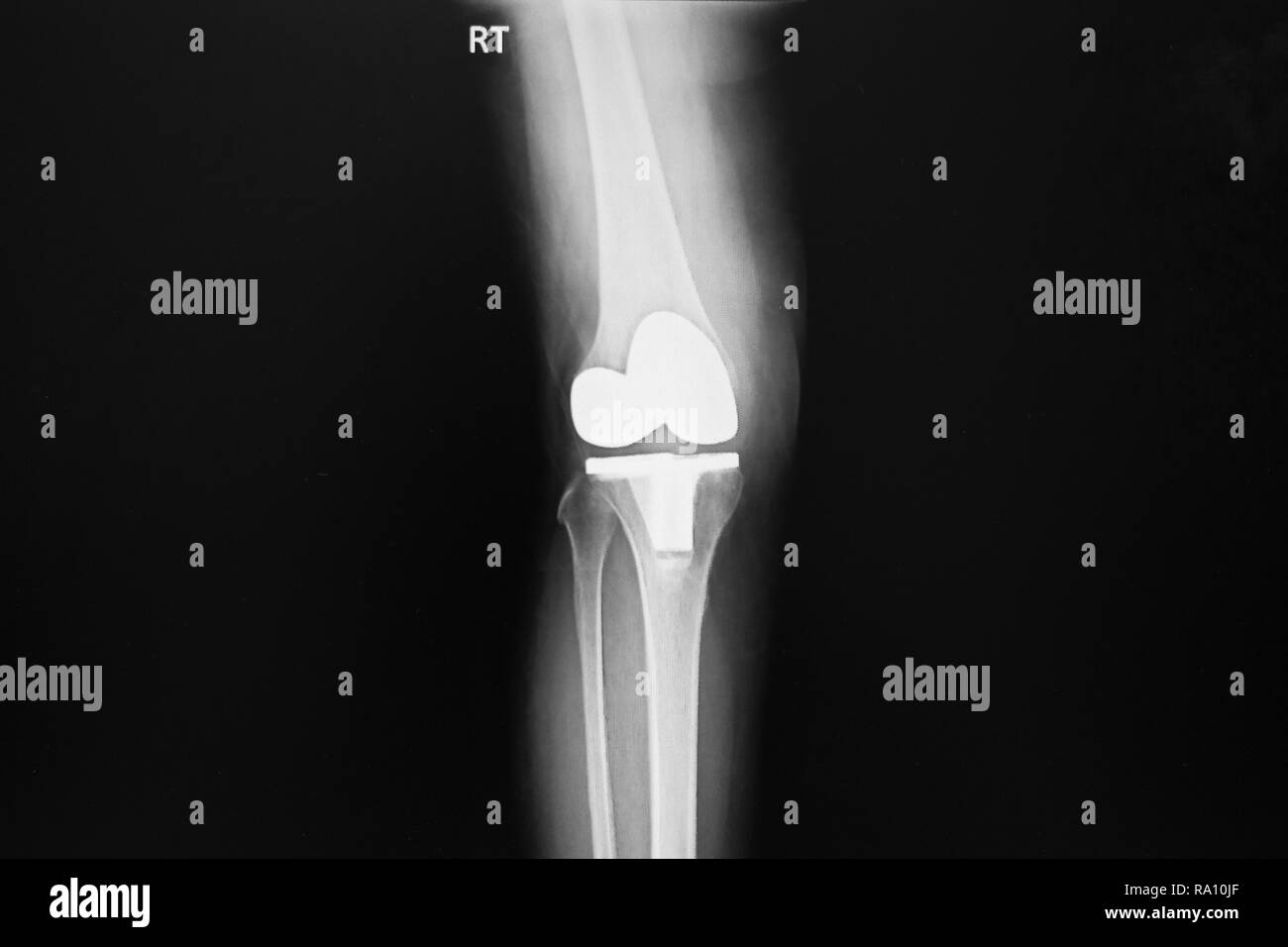 Total knee replacement hi-res stock photography and images - Alamy