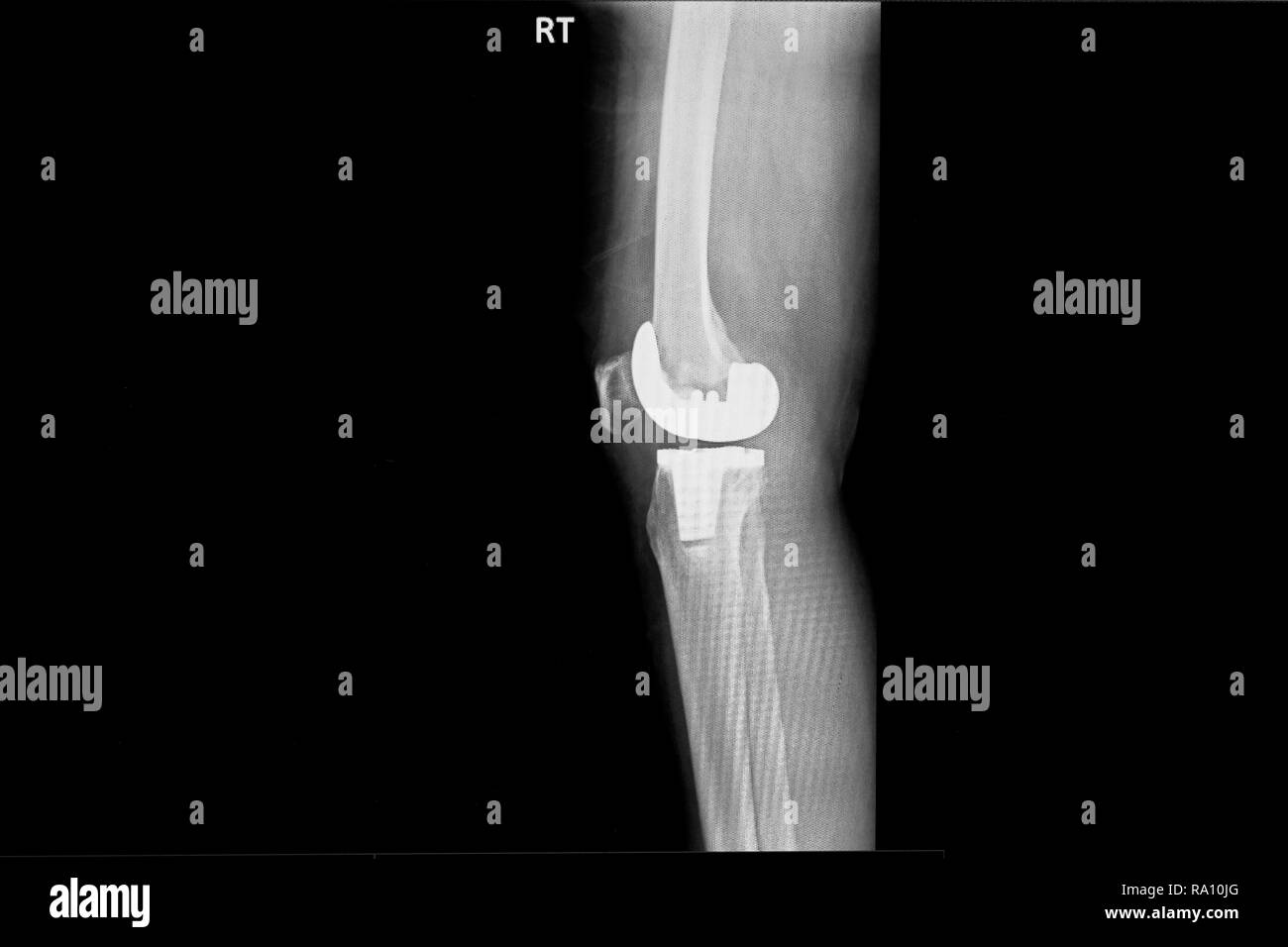 Total knee replacement hi-res stock photography and images - Alamy