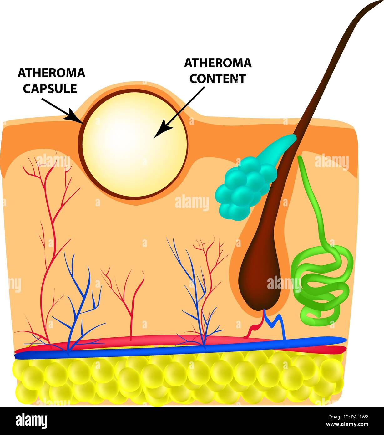 Atheroma structure. The structure of moles on the skin. Infographics ...
