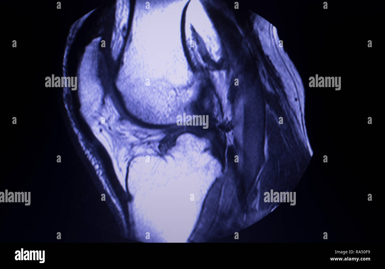 Magnetic resonance imaging MRI knee posterior horn medial meniscus tear ...
