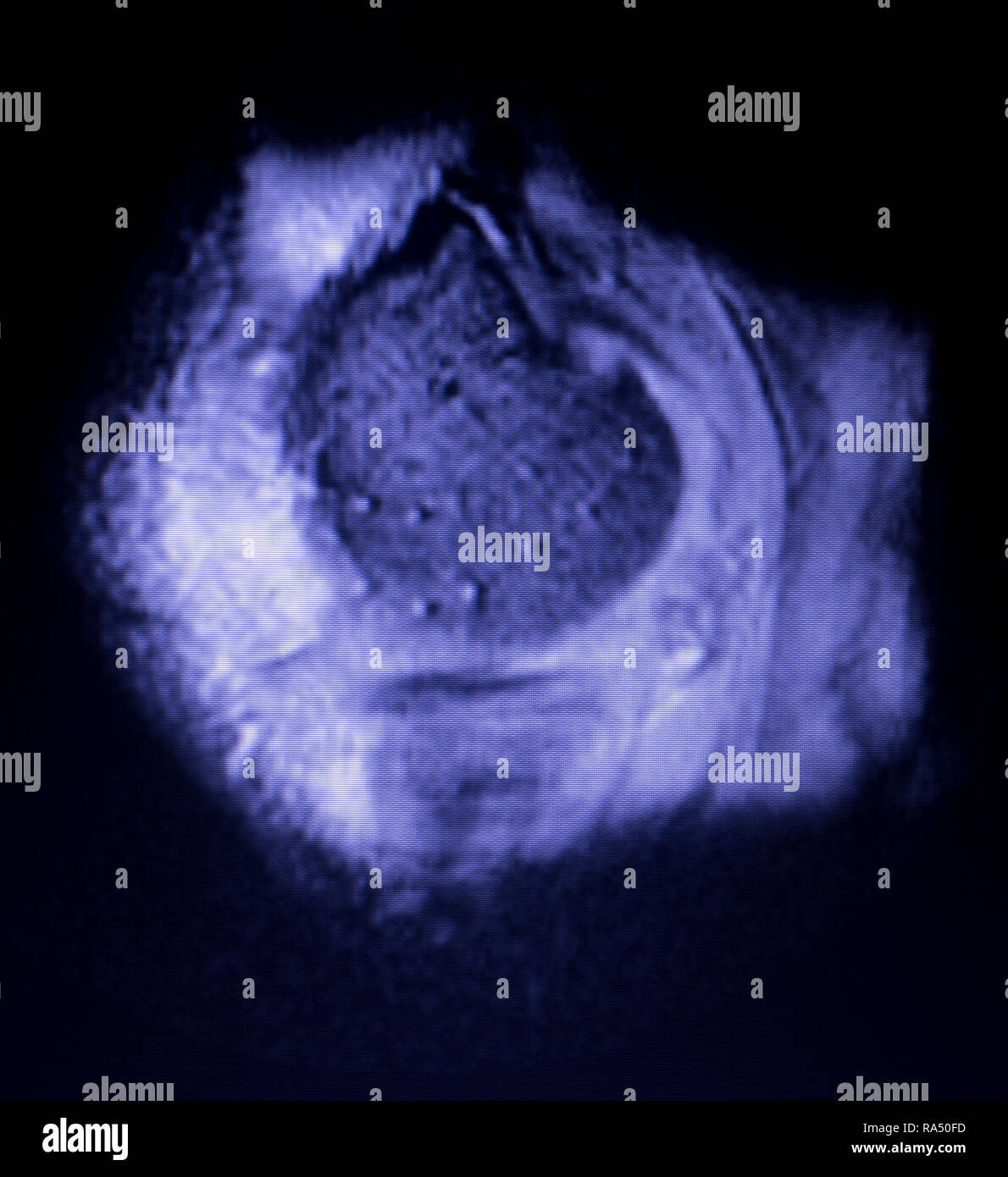 Magnetic resonance imaging MRI knee posterior horn medial meniscus tear ...