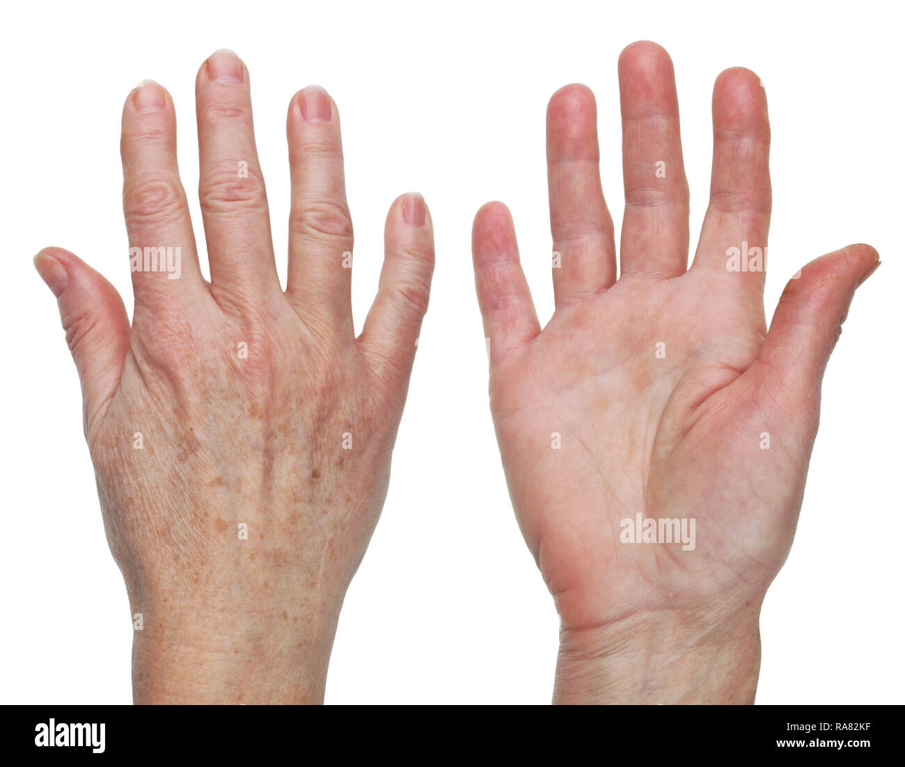 Sore dry skin on the hand of an old woman grandmother. Isolated on ...
