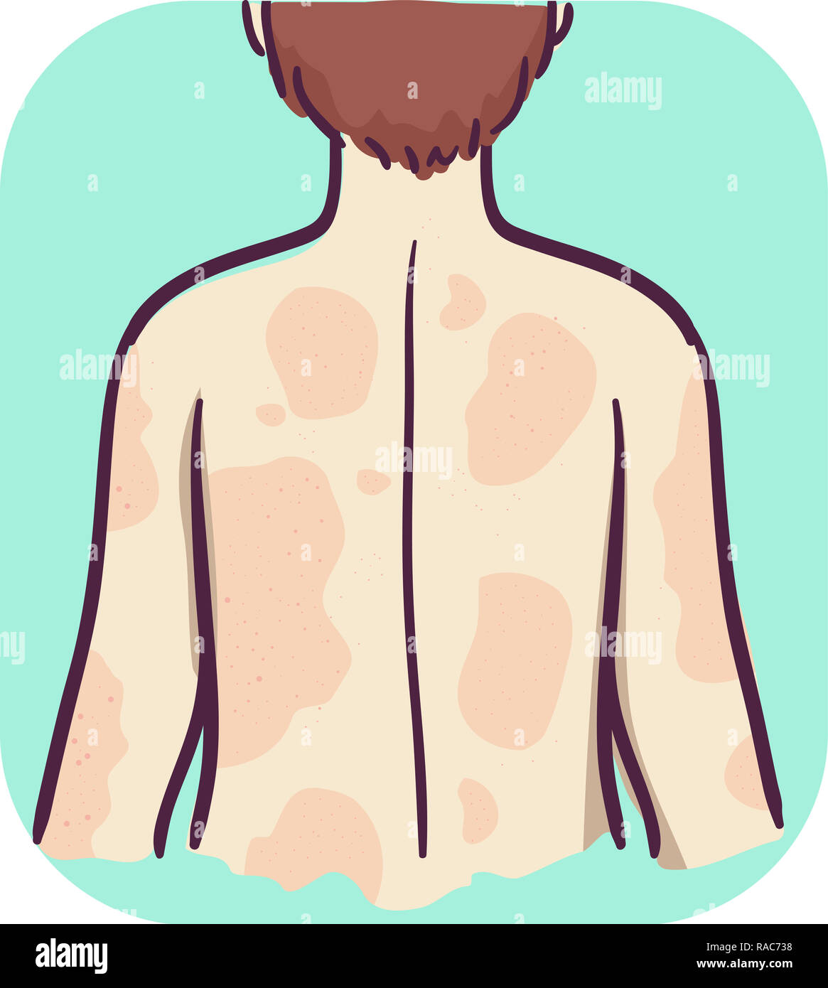 Illustration Of A Man Showing His Back And Breaking Out In Hives Stock