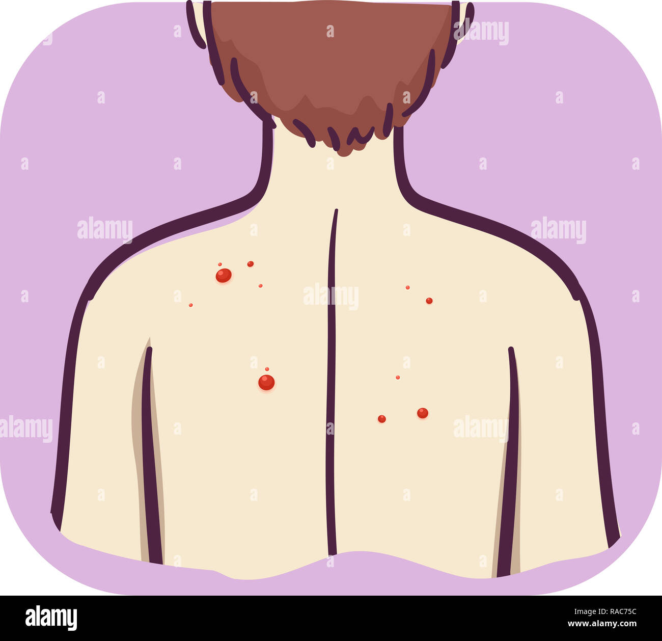 Illustration of a Man with Red Mole or Papule Growth on His Back Stock ...