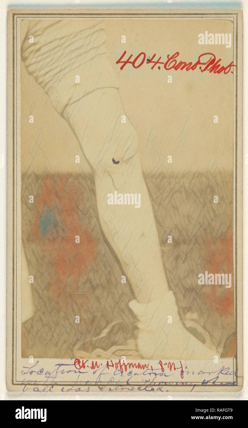 M. Hoffman, Civil War victim, Dr. R.B. Brown (American, active ...