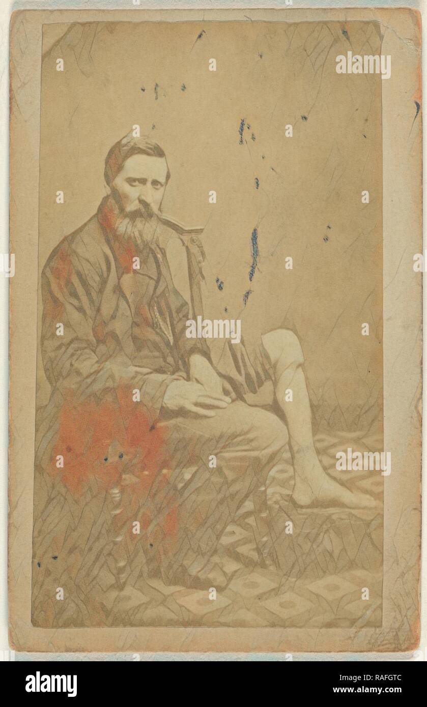 No.5 Case of John Measor U.S.V. Excision of the Tibia, American, 1864 ...