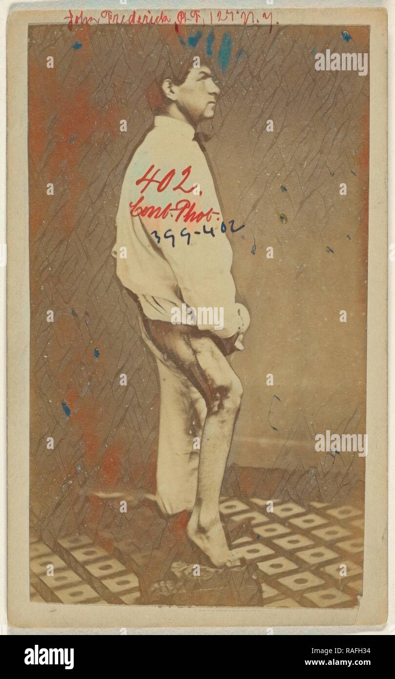 No. 2. Case of John Frederick U.S.V. Side View. Civil War victim ...