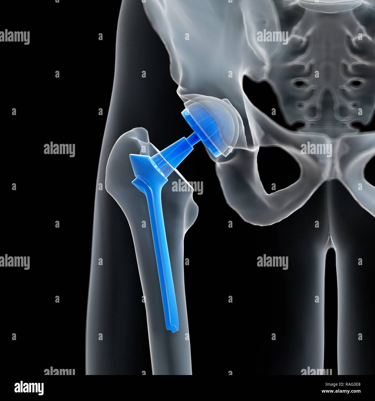 Illustration of a hip replacement Stock Photo - Alamy