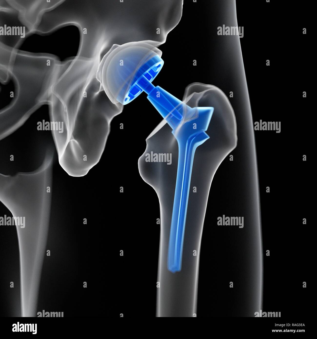 Illustration of a hip replacement Stock Photo - Alamy