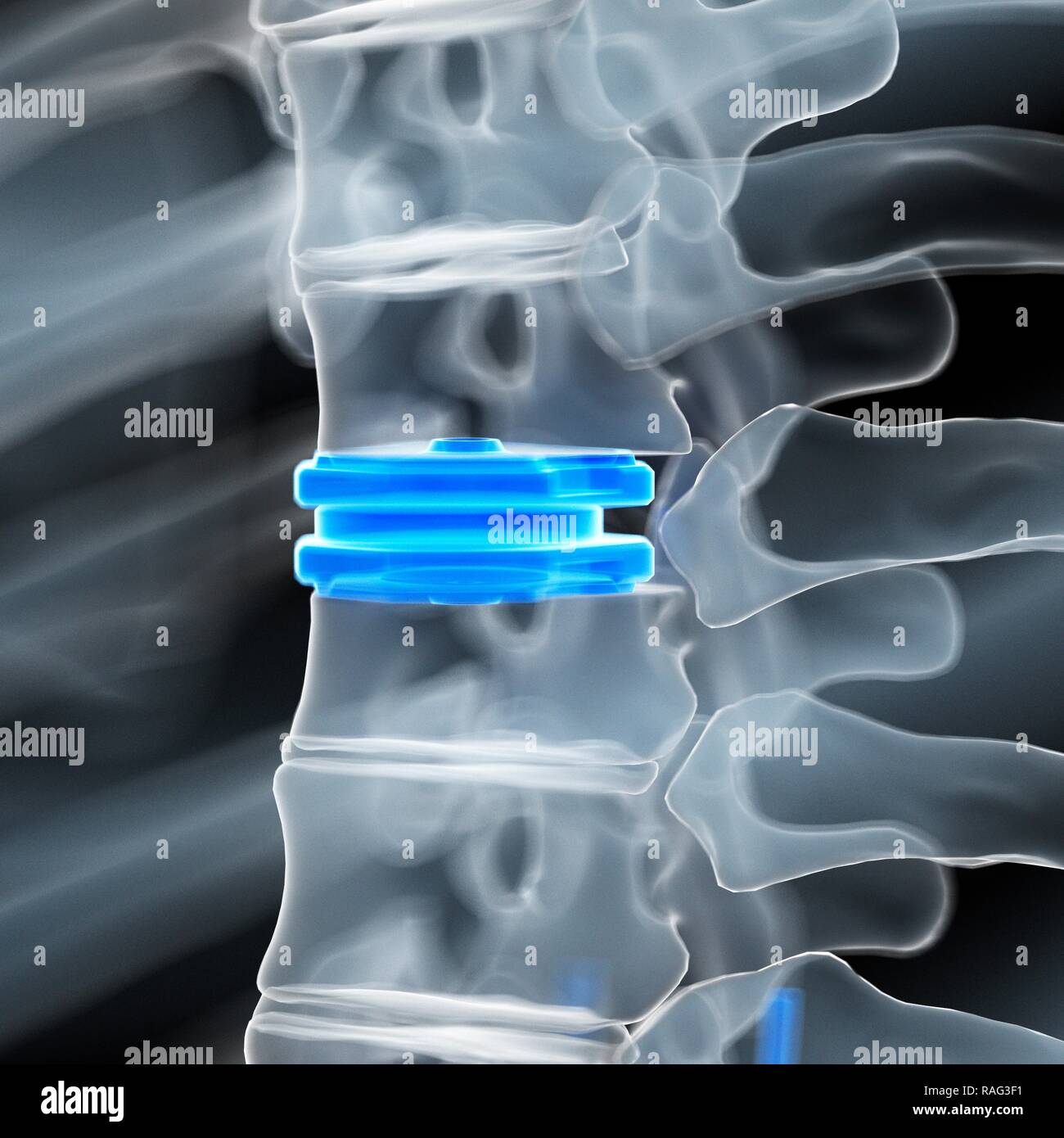 Illustration of a disc replacement Stock Photo - Alamy