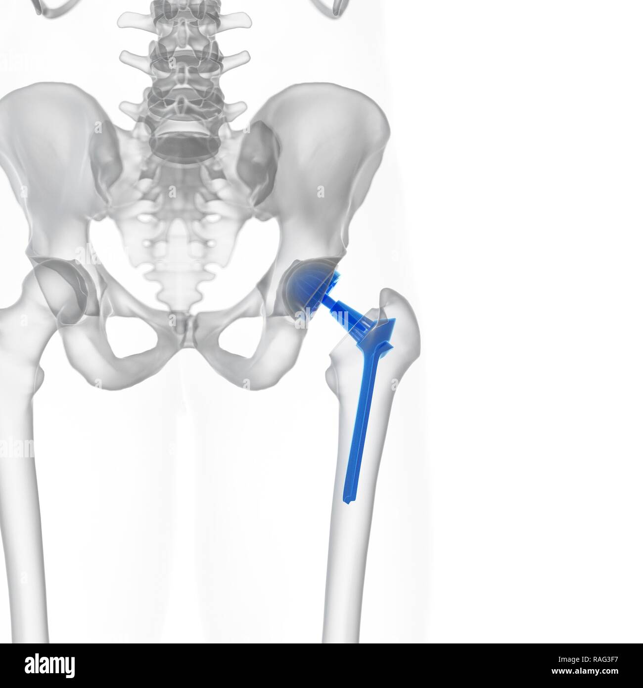 Illustration of a hip replacement Stock Photo - Alamy