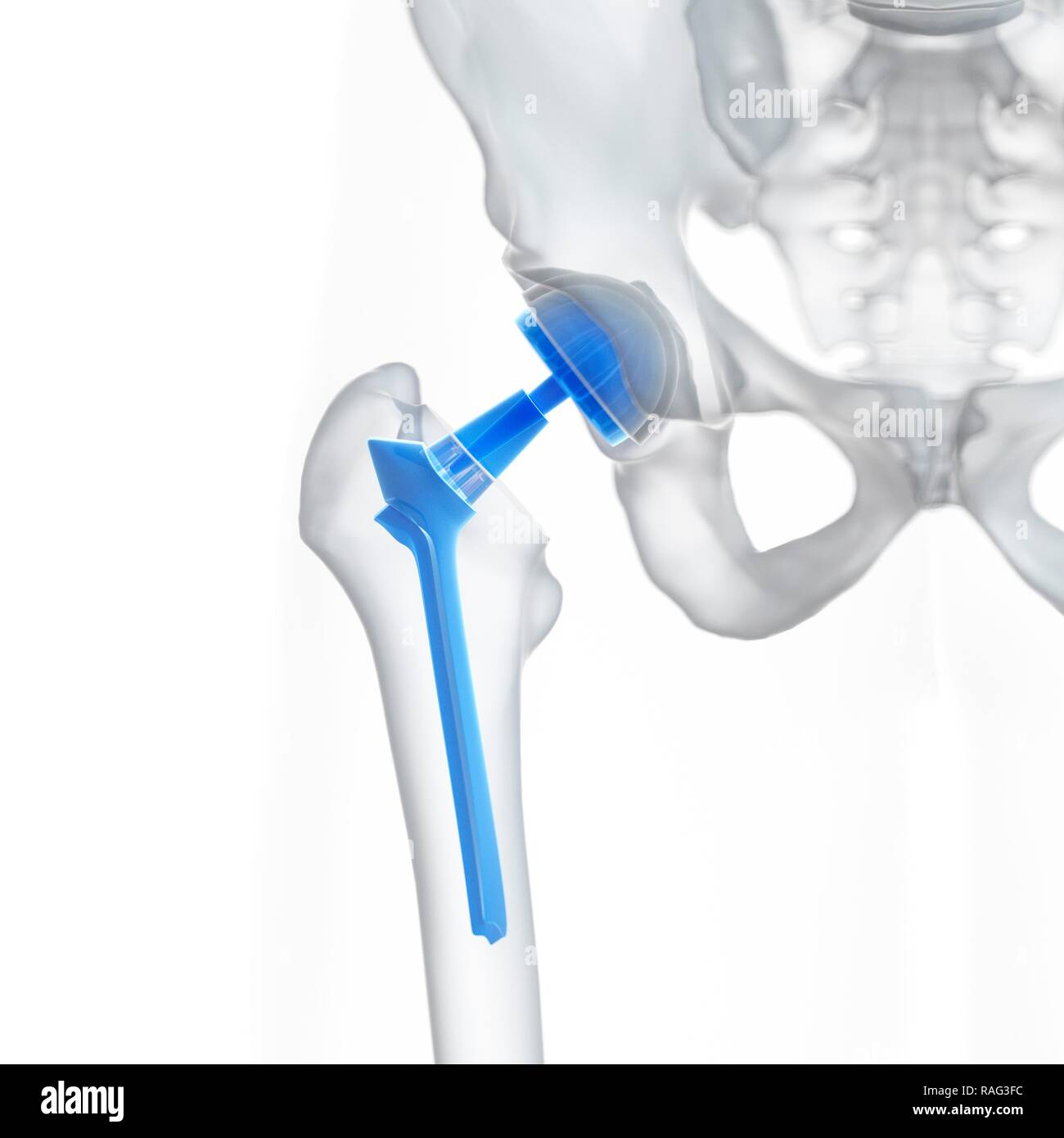Illustration of a hip replacement Stock Photo - Alamy