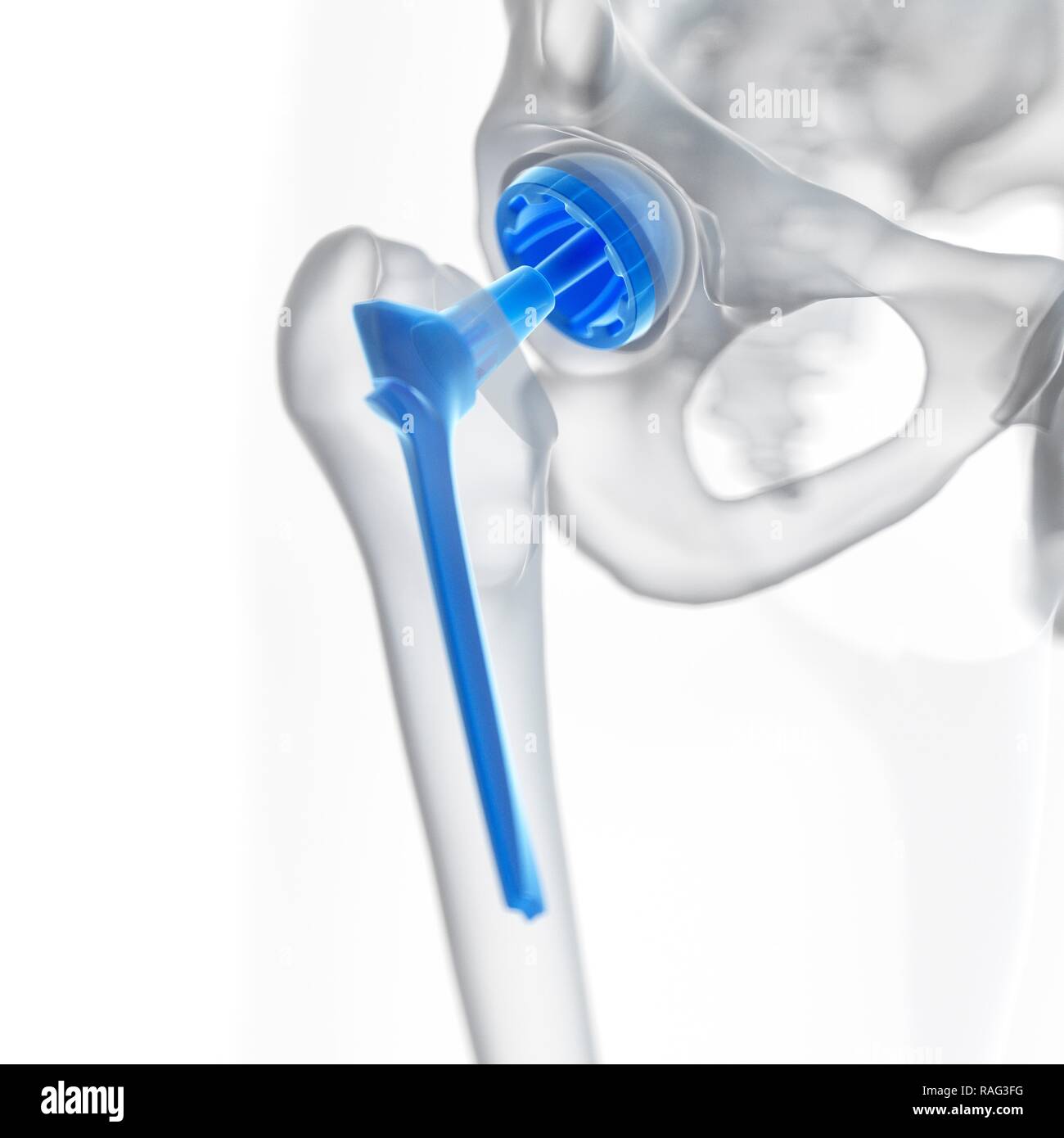 Illustration of a hip replacement Stock Photo - Alamy