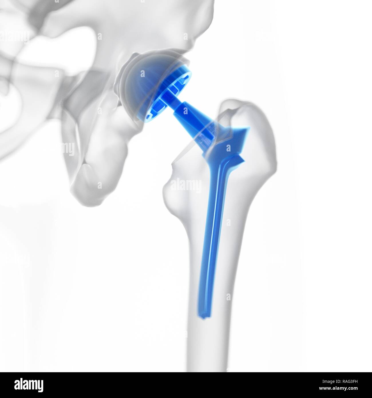 Illustration of a hip replacement Stock Photo - Alamy