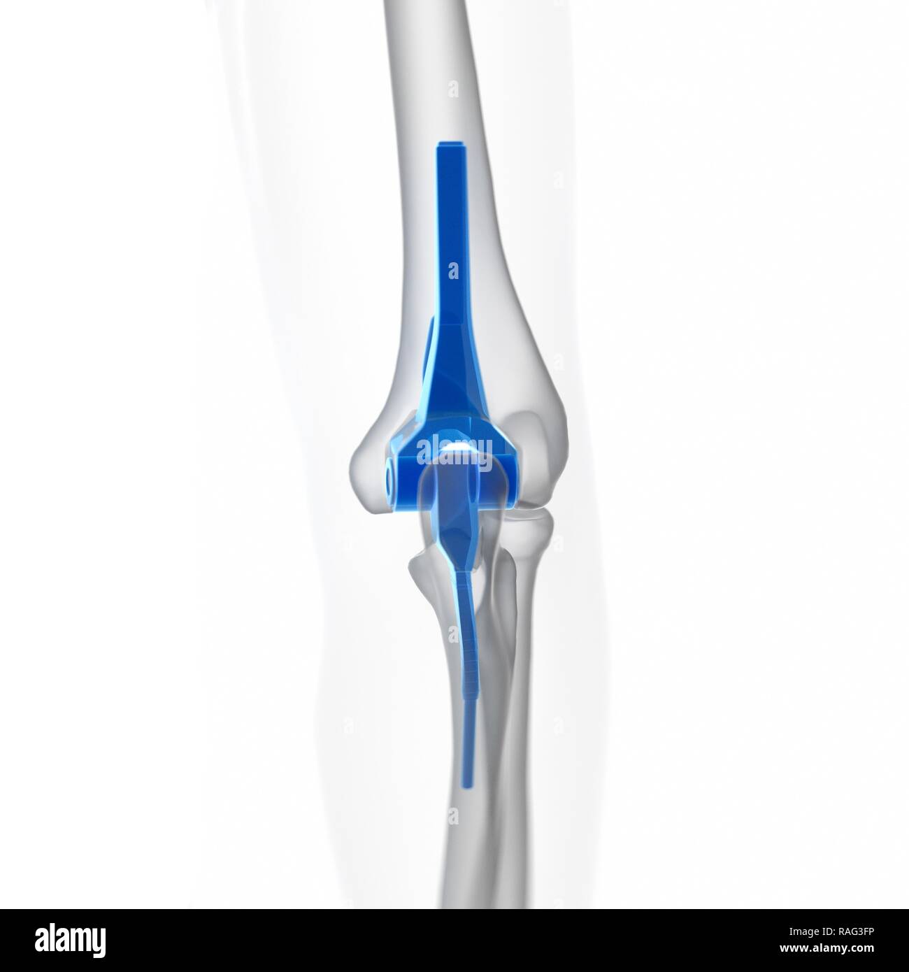 Illustration of an elbow replacement Stock Photo - Alamy