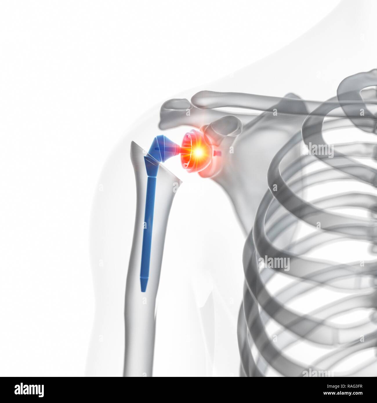 Illustration of a shoulder replacement Stock Photo - Alamy