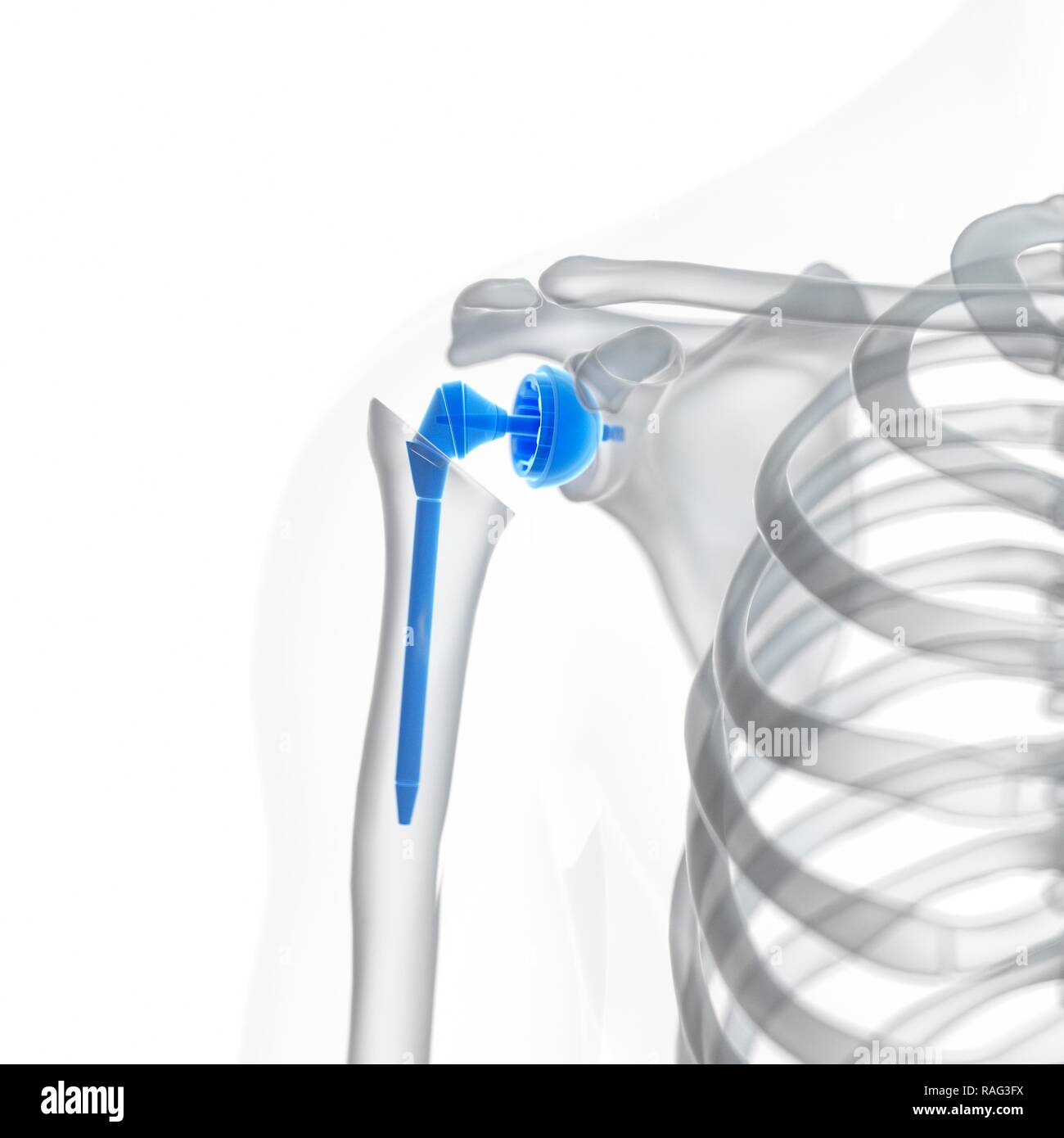 Illustration of a shoulder replacement Stock Photo - Alamy